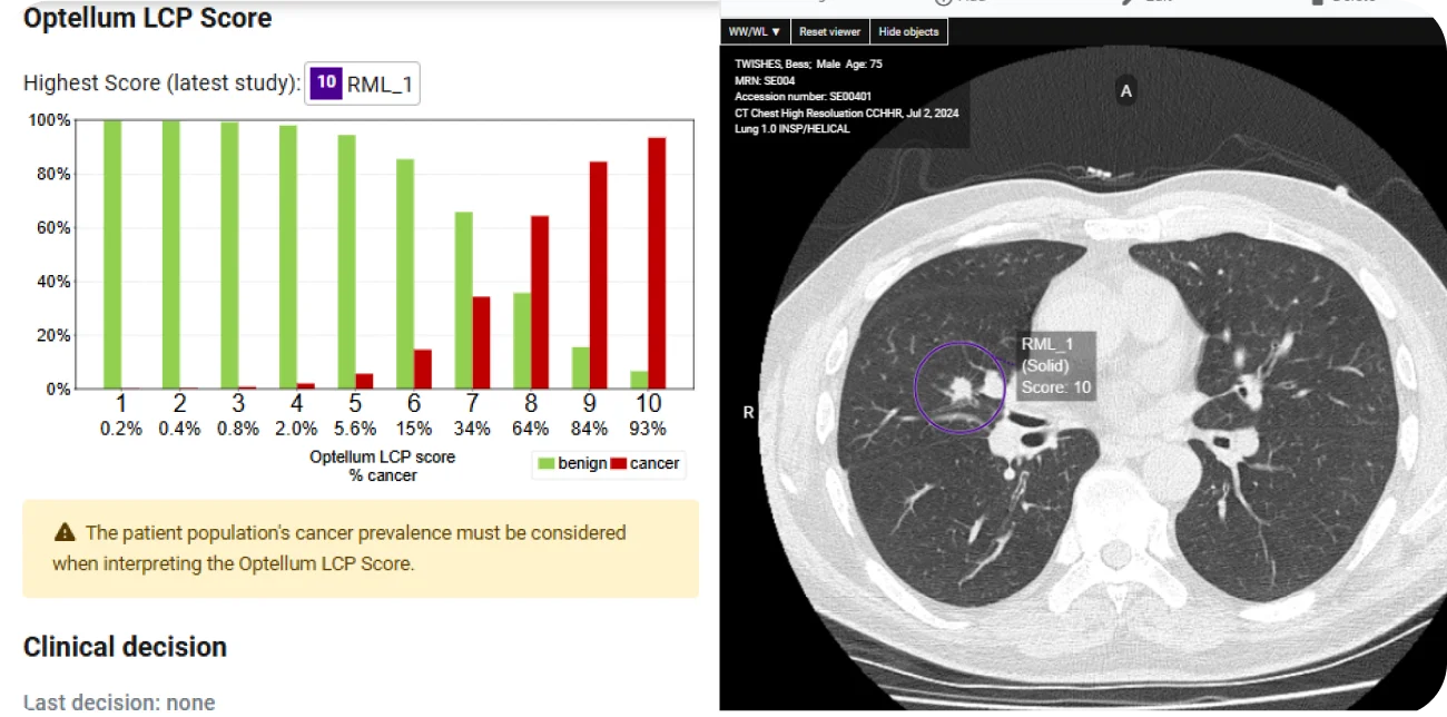 Lung Cancer Prediction (LCP) AI by Optellum | SDV Medical